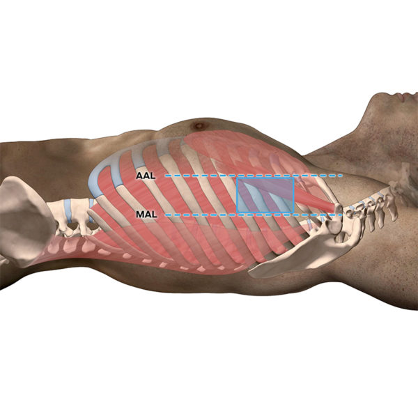 ThoraSite, SAM - Penn Care, Inc.
